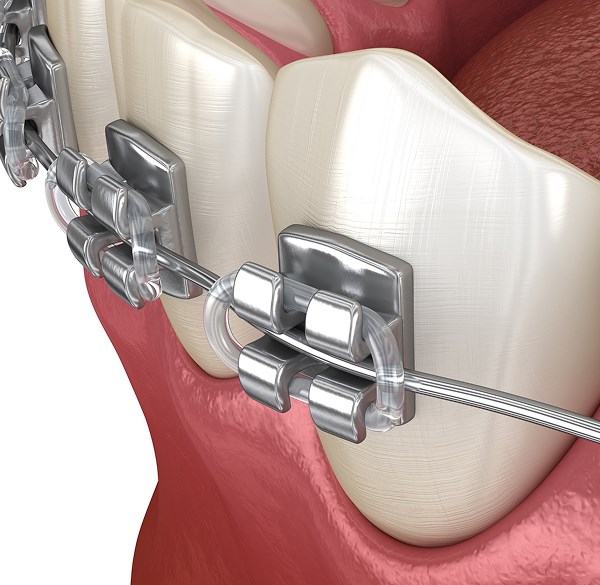 Damon System Braces | Green Orthodontics Solutions